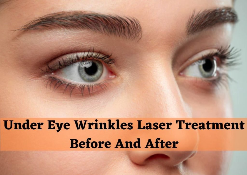 Under Eye Wrinkles Laser Treatment Before And After